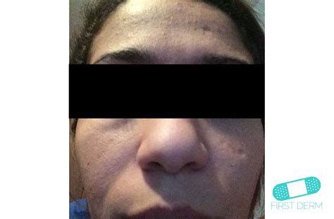 Melasma Chloasma Online Dermatology