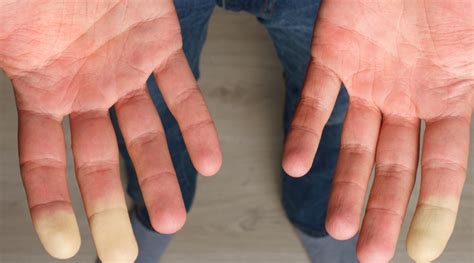 Crest Syndrome Scleroderma Basic Science Orthobullets