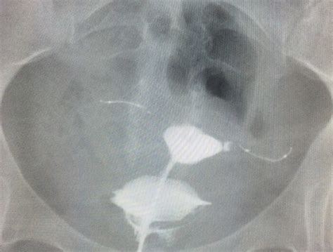 Four Tips For Performing A Hysterosalpingogram Hsg