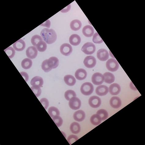 Malaria Stage And Type Detection Object Detection Model By Folahan Fayomi