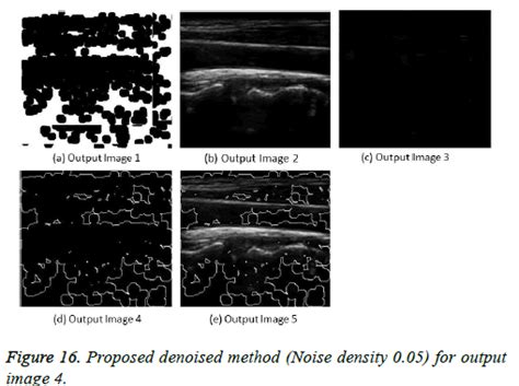Robust Denoising Technique For Ultrasound Images By Splicing Of Low