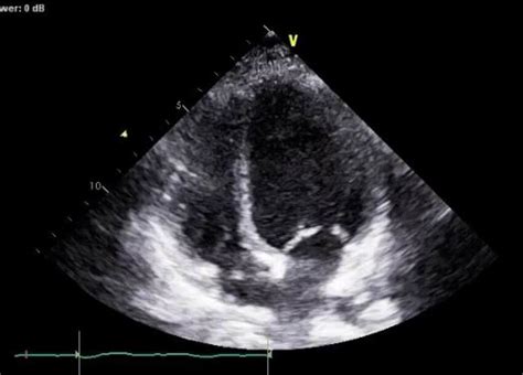 Endomyocardial Biopsy Hematoxylin And Eosin Stain No Significant Inf