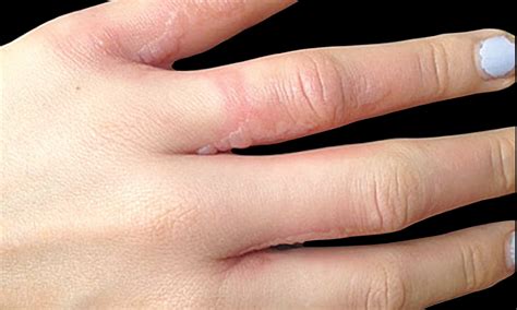 Phytophotodermatitis From Lime Juice The Medical Journal Of Australia
