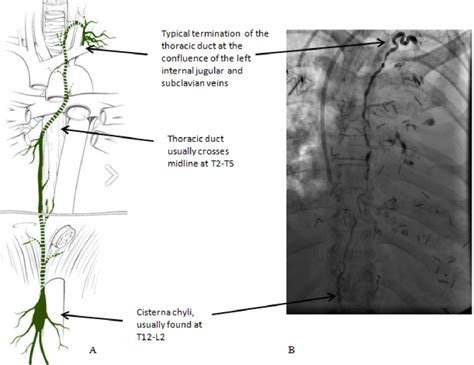 Figure 1 From Imaging And Embolization Illustration Of Variable