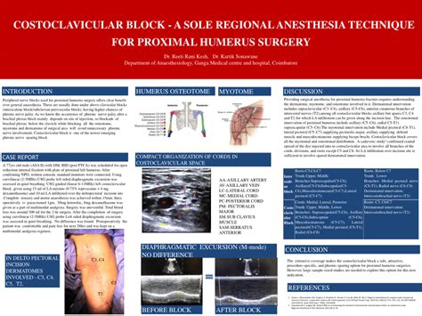 Pdf Costoclavicular Block A Sole Regional Anesthesia Technique For Proximal Humerus Surgery