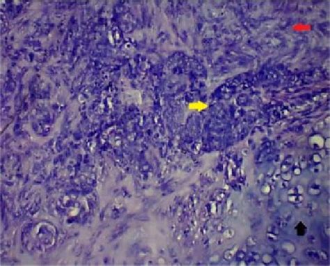 Shows Malignant Epithelial Component Yellow Arrow Sarcomatous