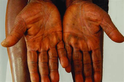 Diffuse Palmar Keratoderma With A Yellowish Hue Download Scientific Diagram