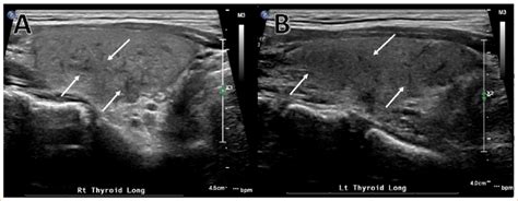 Thyroid Ultrasound Longitudinal View Revealed That The Thyroid Gland
