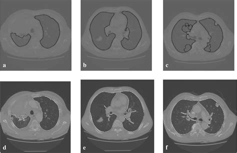 Figure 3 From Pulmonary Nodule Detection Using Chest Ct Images Semantic Scholar