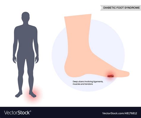 Diabetic Foot Ulcers Royalty Free Vector Image