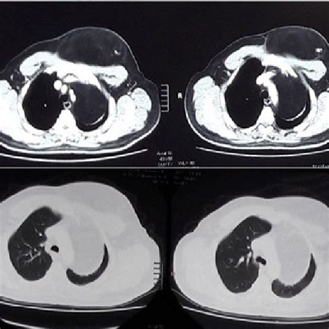 Ct Scan Chest Showing Hypodense Mass Lesion Download Scientific Diagram