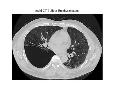 Differential Diagnosis Of Pulmonary Cyst 1 Bullous Emphysema 2