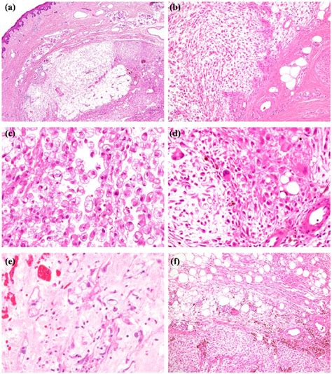 A Myxoinflammatory Fibroblastic Sarcoma Mifs This Was A Download Scientific Diagram