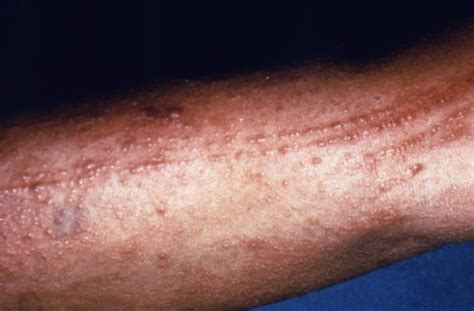 What Does Rash From Poison Oak Look Like