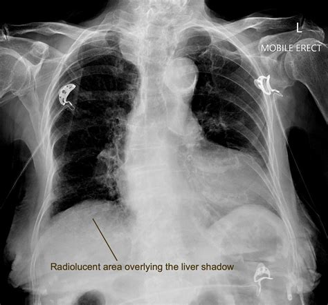 Ct Case 045 Litfl Ct Scan Interpretation