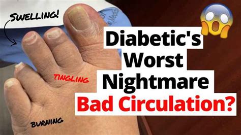 Diabetes Leg Swelling And Redness Treatment Home Remedies