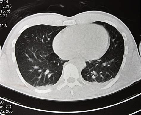 Diagnostic Measures Of Lung Function Decline In COPD