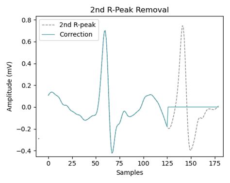 A Example Of Second R Peak Removal From An Afib Ecg Segment Using Download Scientific Diagram