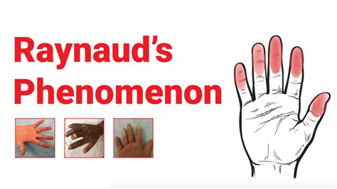 Raynauds Phenomenon What You Should Know Johns Hopkins Rheumtv