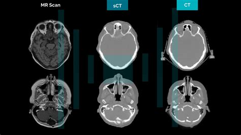 Deep Learning To Generate Synthetic Ct Images From Mr For Radiotherapy
