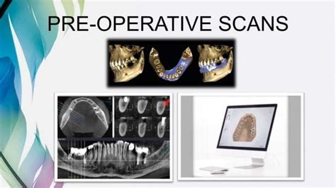 Accuracy Of Computer Aided Implant Placement Pptx