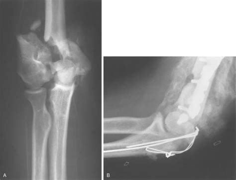 Ectopic Ossification About The Elbow Musculoskeletal Key