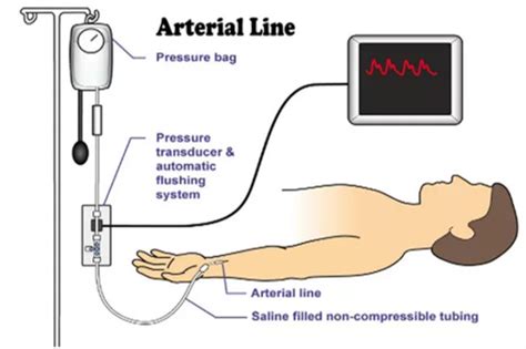 Hemodynamic Monitoring Exam 5 Content Flashcards Quizlet