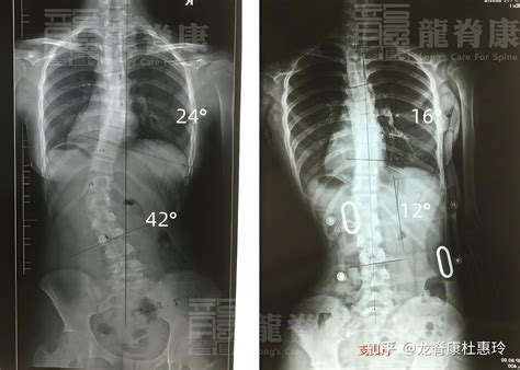 孩子在生长发育期，发现大角度脊柱侧弯怎么办？ 知乎