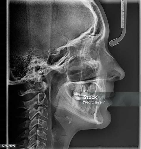 어금니 크라운 충치 임플란트의 치과 엑스레이 중괄호에 대한 구강의 자기 공명 단층 촬영 X 레이에 대한 스톡 사진 및 기타 이미지 Istock
