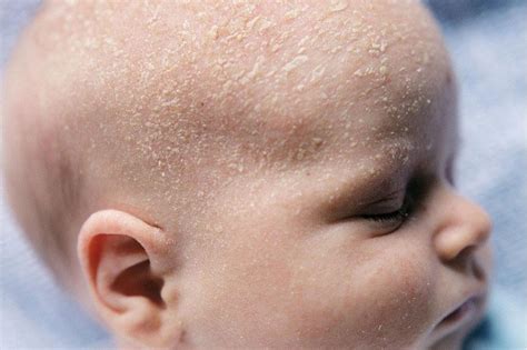 Cradle Cap Symptoms Causes Treatments And Complications Healthdirect Atelier Yuwaciaojp