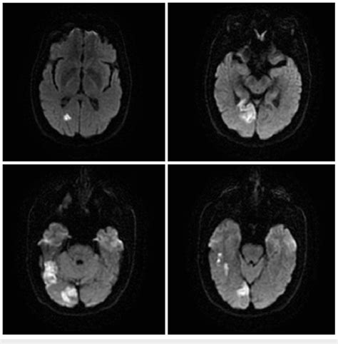 Diffusion Weighted Mri Sequence Showing Increased Signal Intensity In