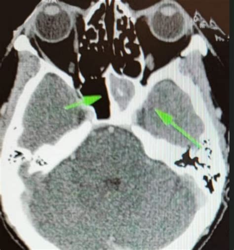 Isolated Fungal Sphenoiditis Isolated Sphenoid Fungal Sinusitis