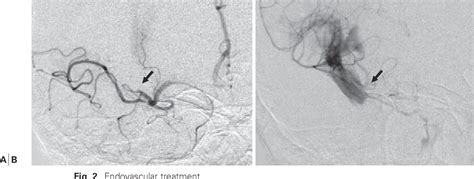 Figure 3 From Troubleshooting Intraprocedural Arterial Perforation During Acute
