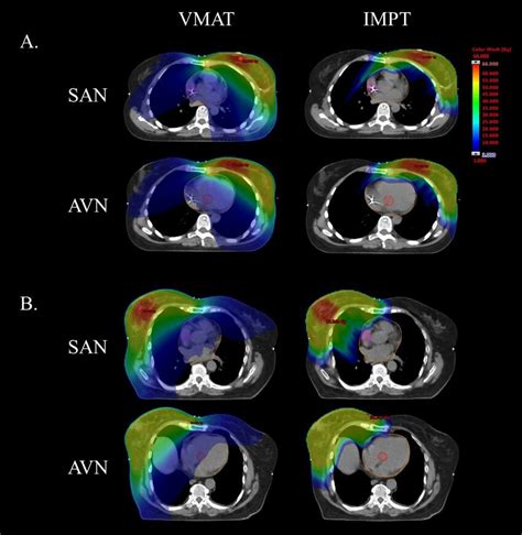 Conduction Node Exposure With Volumetric Modulated Arc Therapy Vmat Download Scientific