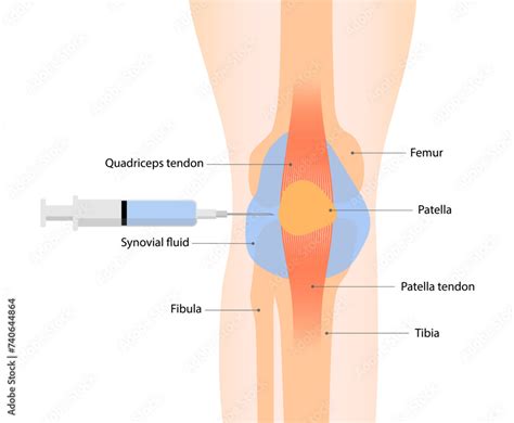 Knee Arthrocentesis Or Synovial Fluid Aspiration For Relieve Pain And Swelling Caused By Knee Arthrocentesis Or Synovial Fluid Aspiration For Relieve Pain And Swelling Caused By
