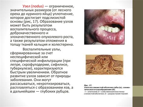 Элементы поражения слизистой оболочки полости рта Первичные элементы поражения Online
