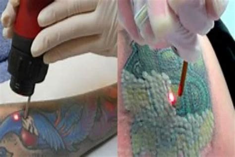 Demystifying Laser Crystal Types A Guide To Choosing The Right Crystal For Medical Aesthetic