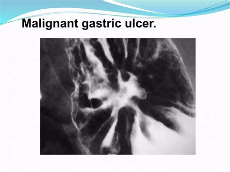 Radiological Approach To Gastric Ulcer Disease Pptx