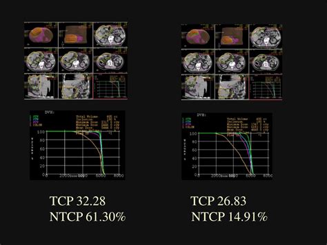 Ppt Clinical Application Of Tcp ・ Ntcp Powerpoint Presentation Free