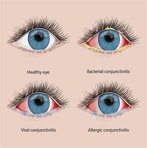 Demystifying Conjunctivitis Causes Symptoms Prevention And Treatment Svision