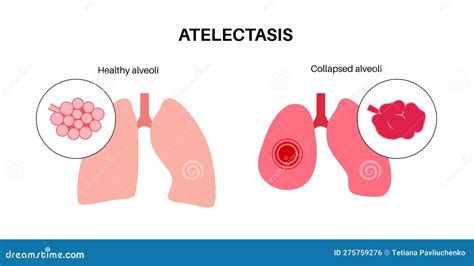 Atelectasis Medical Poster Vector Illustration 275670916