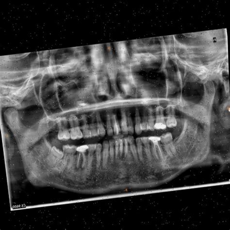 Tooth Process Detection Object Detection Dataset And Pre Trained Model