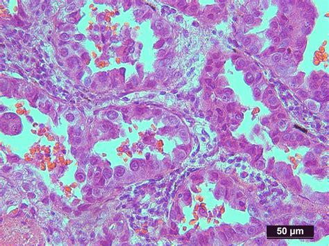 Human Tumor Ffpe Sections Archives