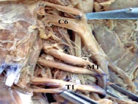 Left Side Of The Neck Showing A Postfixed Plexus Download Scientific