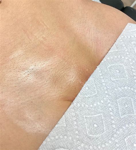 Brazilian Wax Results Photos