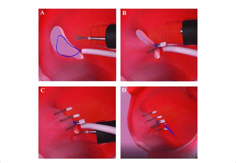 Illustration Of The Kissing Suture Method A Nylon Loops Along