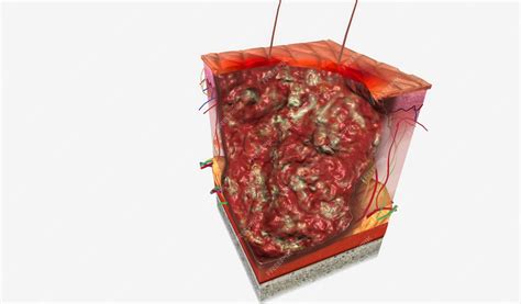 Premium Photo Pyoderma Gangrenosum Stage Iii3d