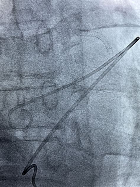 Patient Underwent Lad Stenting Yesterday Ciya Sabu