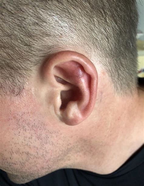 Melanoma On Ear At Hubert Moreno Blog