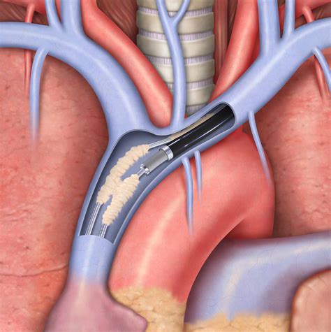Cook Medical Reintroduces Its Evolution Rl Lead Extraction Products To